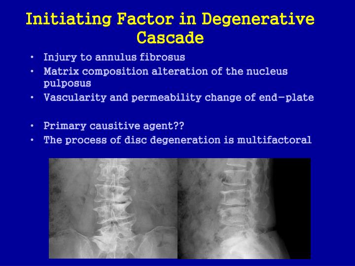 PPT - Lumbar Disc Herniation and Radiculopathy PowerPoint Presentation ...