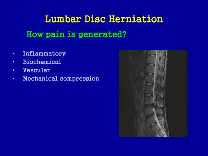 PPT - Lumbar Disc Herniation and Radiculopathy PowerPoint Presentation ...