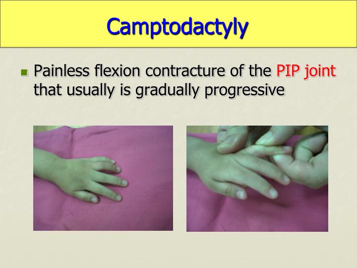 PPT - Rehabilitation of Congenital Limb Anomalies PowerPoint ...