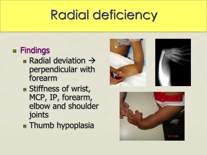 PPT - Rehabilitation of Congenital Limb Anomalies PowerPoint ...
