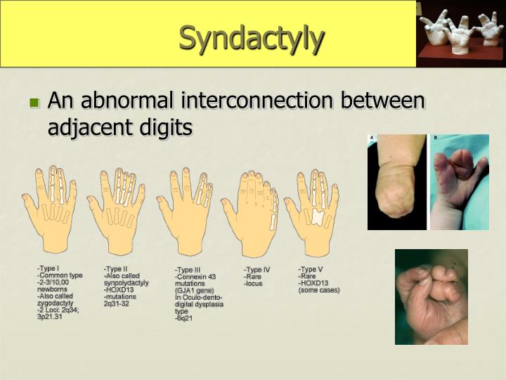 PPT - Rehabilitation of Congenital Limb Anomalies PowerPoint ...