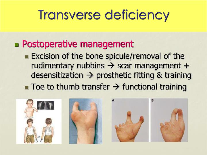 PPT - Rehabilitation of Congenital Limb Anomalies PowerPoint ...