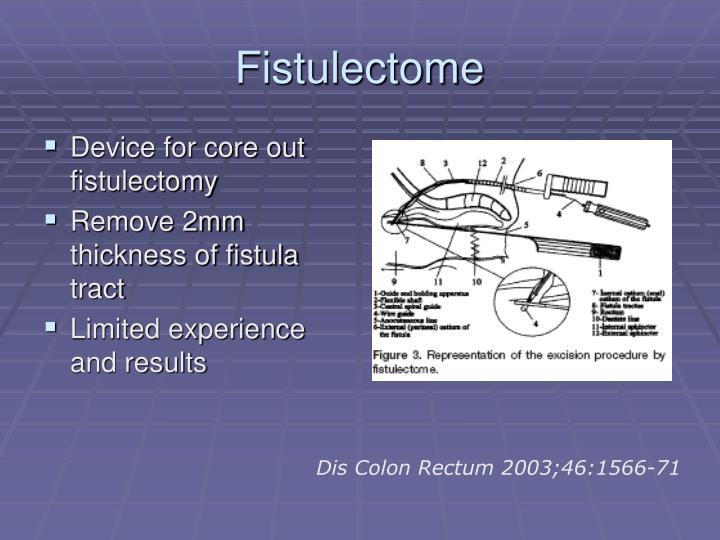 PPT - Treatment for Anal fistula PowerPoint Presentation - ID:1202646