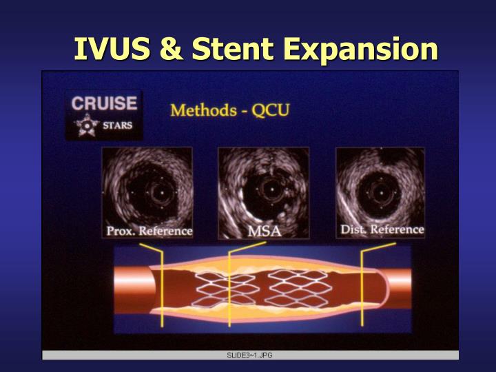 PPT - When I Use IVUS Neal Uren MD FRCP Consultant Cardiologist Royal ...
