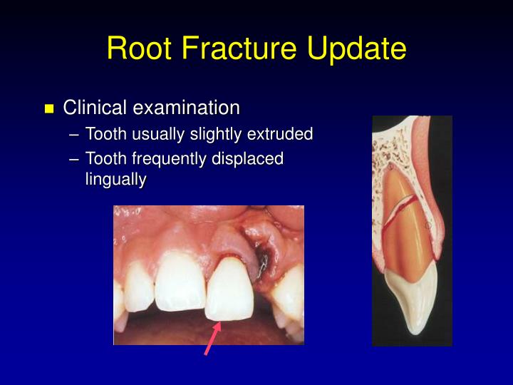 PPT - Traumatic Injuries to the Teeth PowerPoint Presentation - ID:1214569