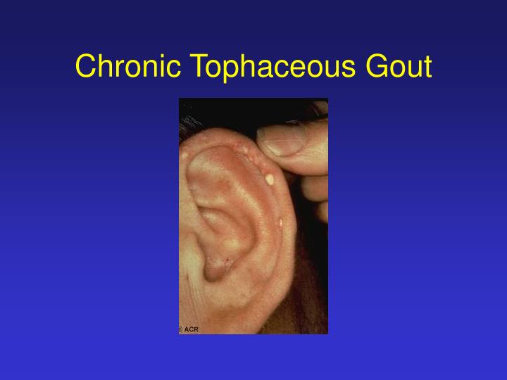 PPT - Crystal-induced Arthropathy: Gout and Pseudogout PowerPoint ...