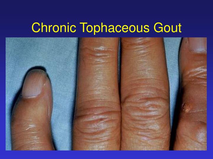 PPT - Crystal-induced Arthropathy: Gout and Pseudogout PowerPoint ...