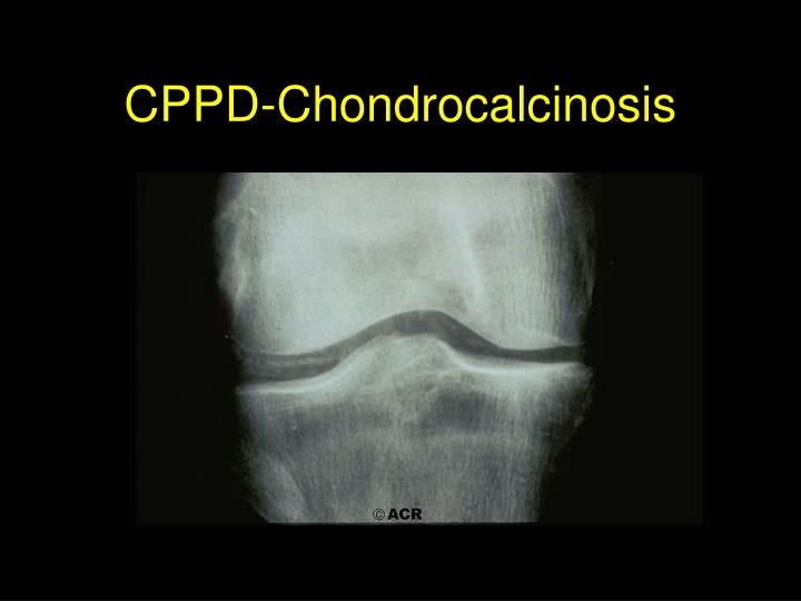 PPT - Crystal-induced Arthropathy: Gout and Pseudogout PowerPoint ...