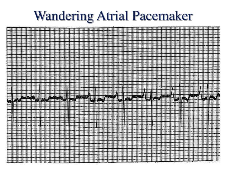PPT - Cardiac Dysrhythmias PowerPoint Presentation - ID:1224455