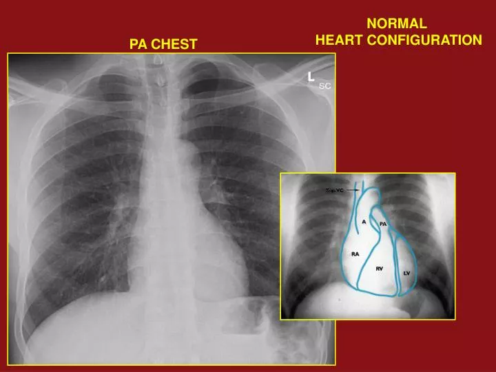 PPT - NORMAL HEART CONFIGURATION PowerPoint Presentation, free download ...