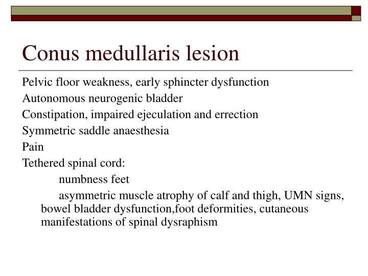 Conus Medullaris Syndrome Springerlink