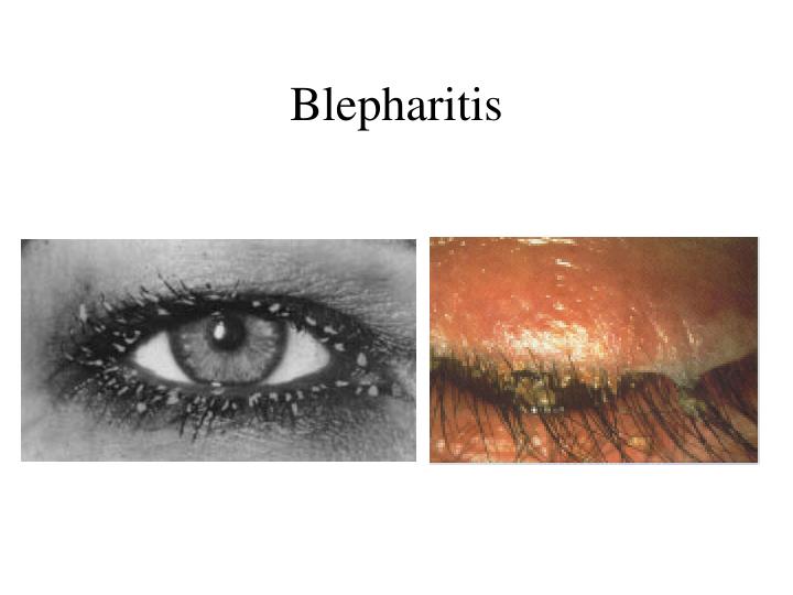 PPT - Dermatological disorders in children PowerPoint Presentation - ID ...