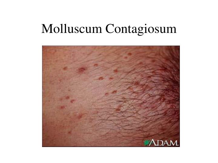PPT - Dermatological disorders in children PowerPoint Presentation - ID ...