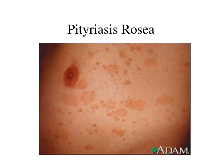 PPT - Dermatological disorders in children PowerPoint Presentation - ID ...