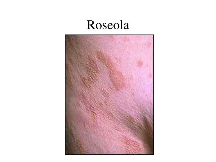 PPT - Dermatological disorders in children PowerPoint Presentation - ID ...