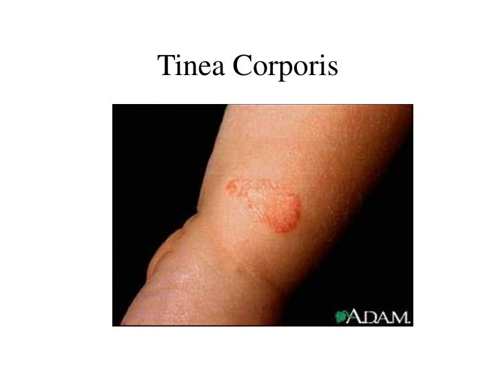 PPT - Dermatological disorders in children PowerPoint Presentation - ID ...