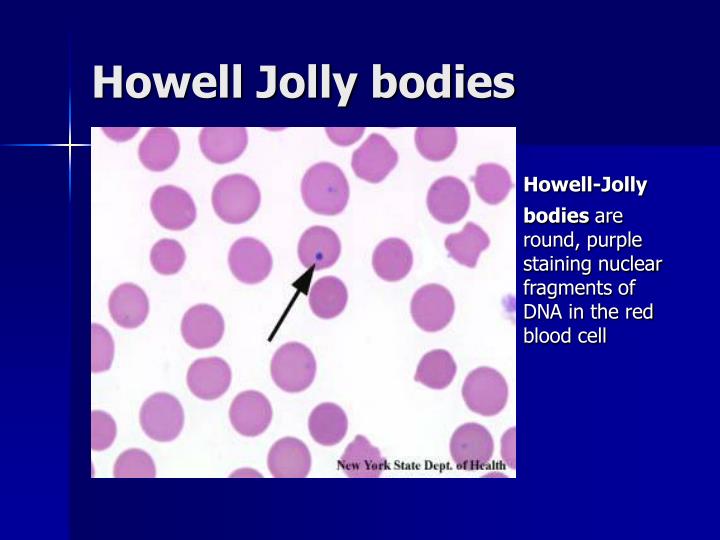 PPT - Hyposplenism PowerPoint Presentation - ID:1227809