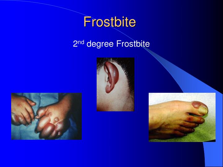 PPT - COLD WEATHER INJURY PREVENTION IN AFGHANISTAN PowerPoint ...