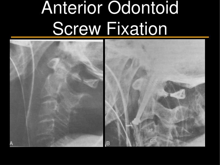 PPT - Surgical Approach: Fixation at C1-2 PowerPoint Presentation - ID ...
