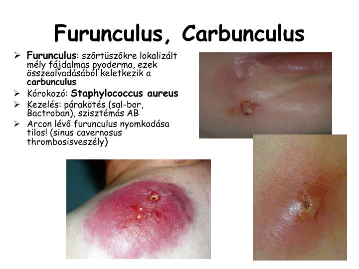 PPT - A leggyakoribb infekciós eredetű bőrgyógyászati kórképek ...
