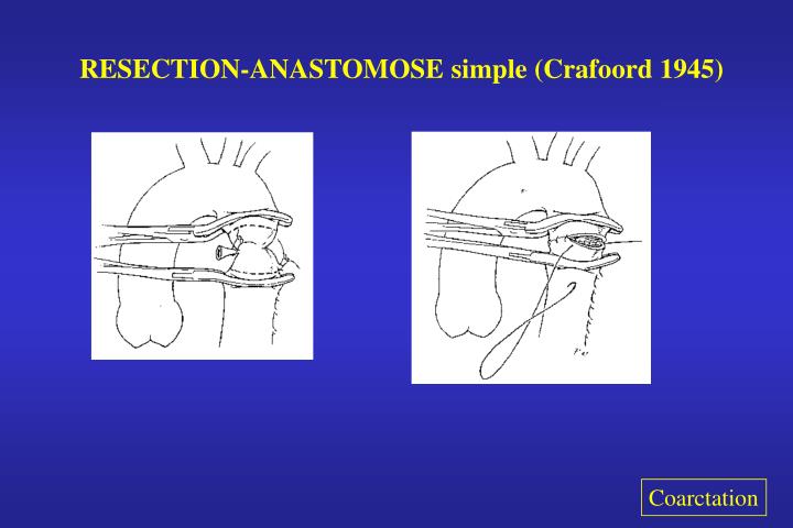 PPT - COARCTATION AORTIQUE El Arid Jean-Marc, Pr Olivier Baron, Pr ...