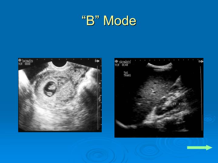 PPT - Ultrasound Physics PowerPoint Presentation - ID:1244413