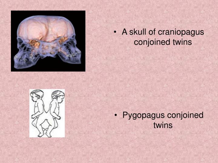 PPT - Conjoined Twins PowerPoint Presentation - ID:1245222