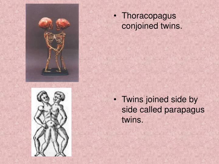 PPT - Conjoined Twins PowerPoint Presentation - ID:1245222