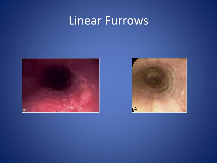 PPT - Overview of Eosinophilic Esophagitis PowerPoint Presentation - ID ...