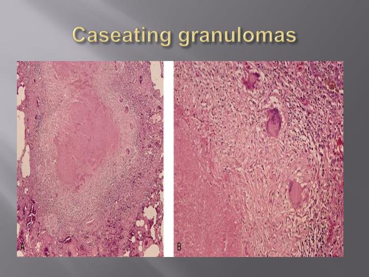 PPT - Granulomatous Diseases: PowerPoint Presentation - ID:1249363