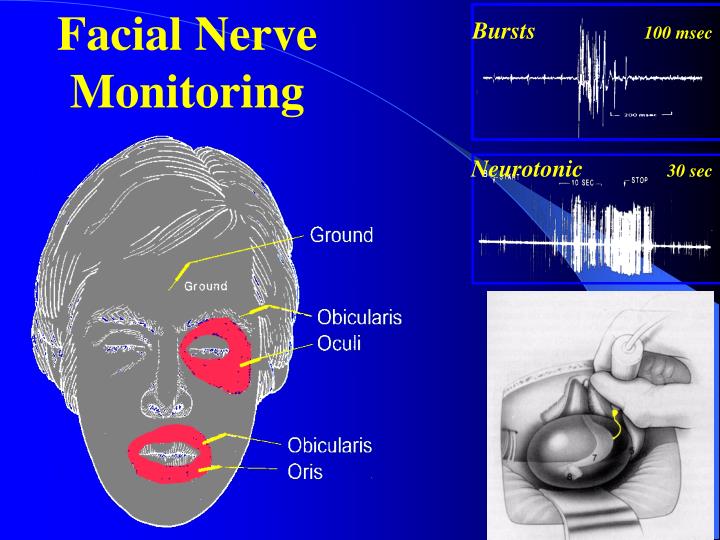PPT - INTRAOPERATIVE NEUROPHYSIOLOGY AND NEUROMONITORING PowerPoint ...