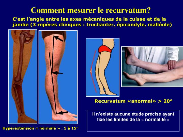 PPT - Genu recurvatum PowerPoint Presentation - ID:1251041