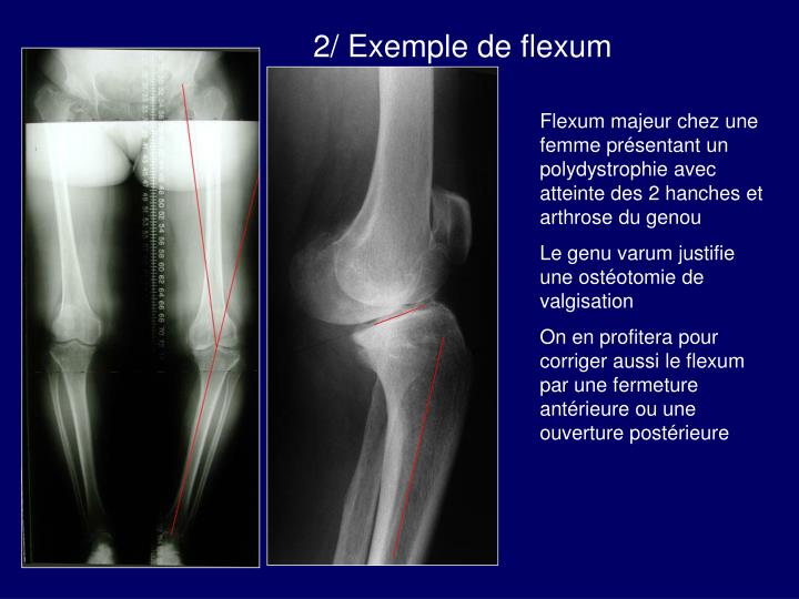 PPT - Genu recurvatum PowerPoint Presentation - ID:1251041