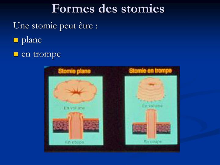 PPT - LES STOMIES DIGESTIVES PowerPoint Presentation - ID:1251343