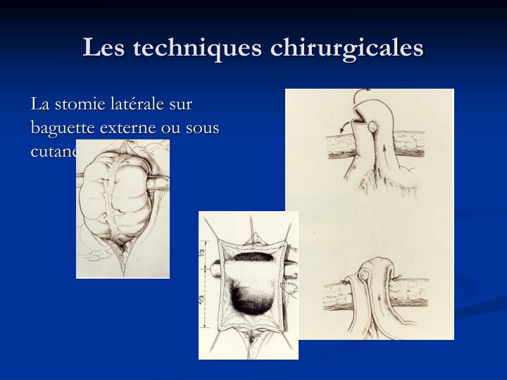 PPT - LES STOMIES DIGESTIVES PowerPoint Presentation - ID:1251343