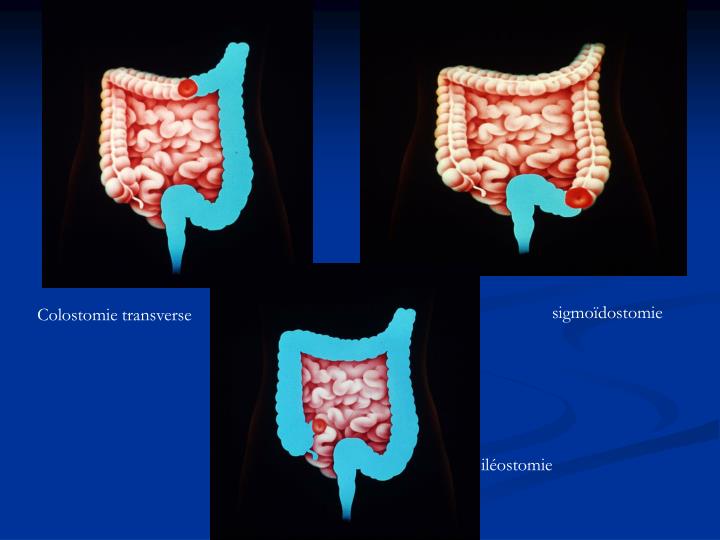PPT - LES STOMIES DIGESTIVES PowerPoint Presentation - ID:1251343