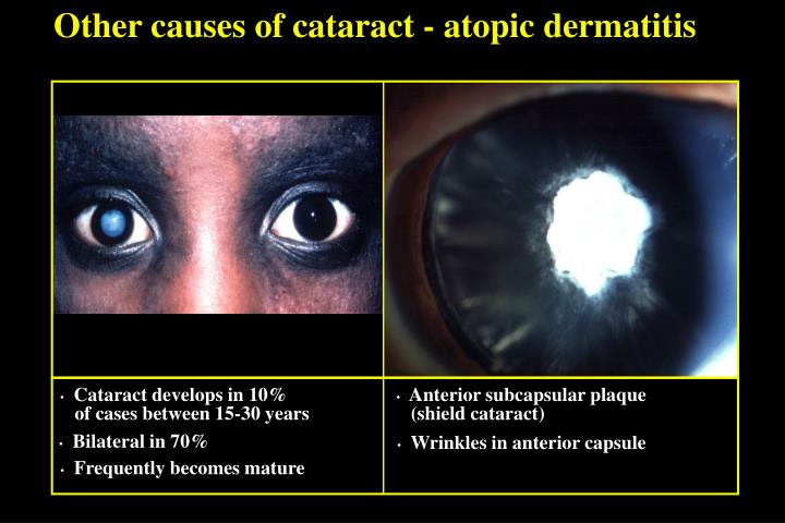 PPT - ACQUIRED CATARACT PowerPoint Presentation - ID:1251889