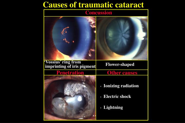 PPT - ACQUIRED CATARACT PowerPoint Presentation - ID:1251889