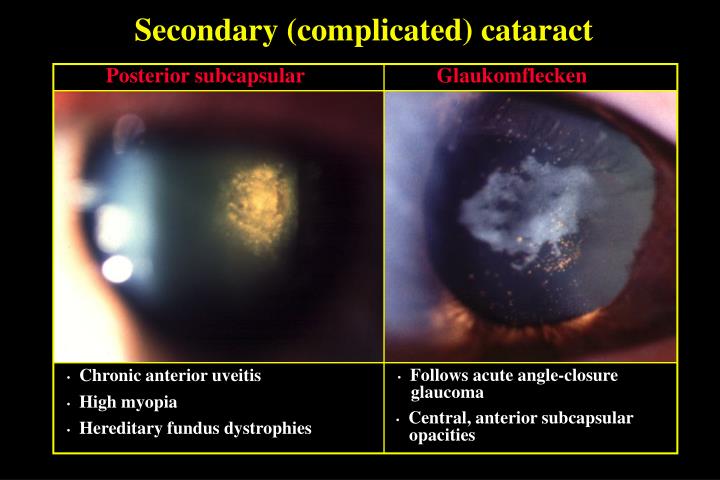 PPT - ACQUIRED CATARACT PowerPoint Presentation - ID:1251889