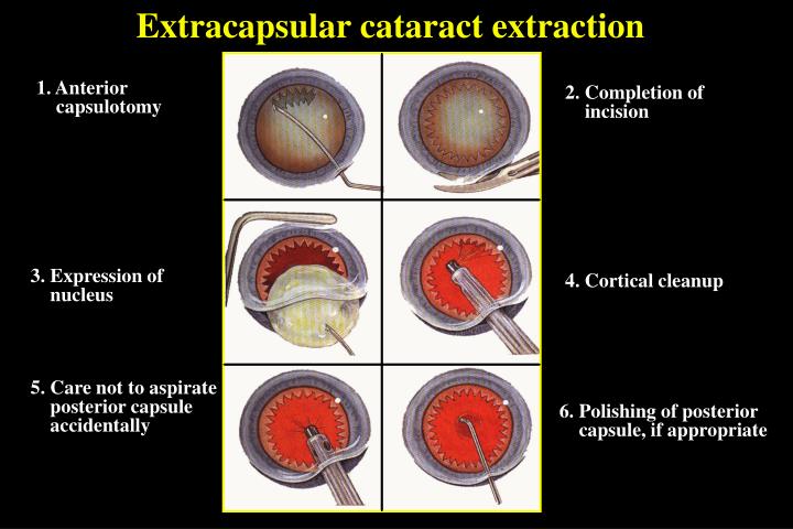 PPT - ACQUIRED CATARACT PowerPoint Presentation - ID:1251889