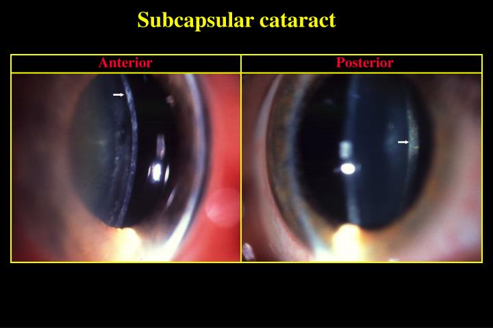 PPT - ACQUIRED CATARACT PowerPoint Presentation - ID:1251889