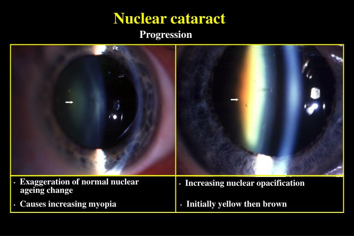 PPT - ACQUIRED CATARACT PowerPoint Presentation - ID:1251889