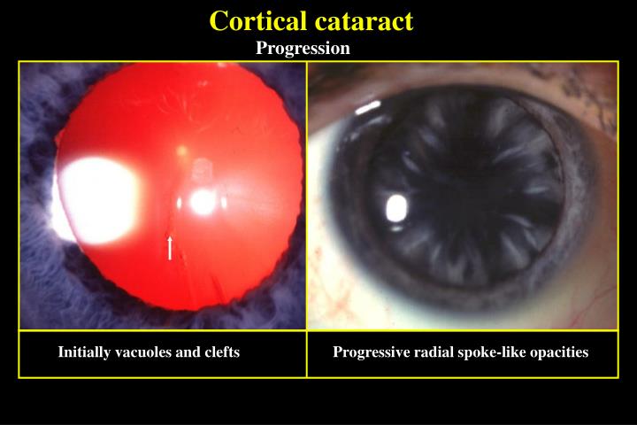PPT - ACQUIRED CATARACT PowerPoint Presentation - ID:1251889