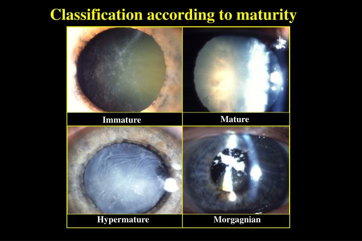 PPT - ACQUIRED CATARACT PowerPoint Presentation - ID:1251889