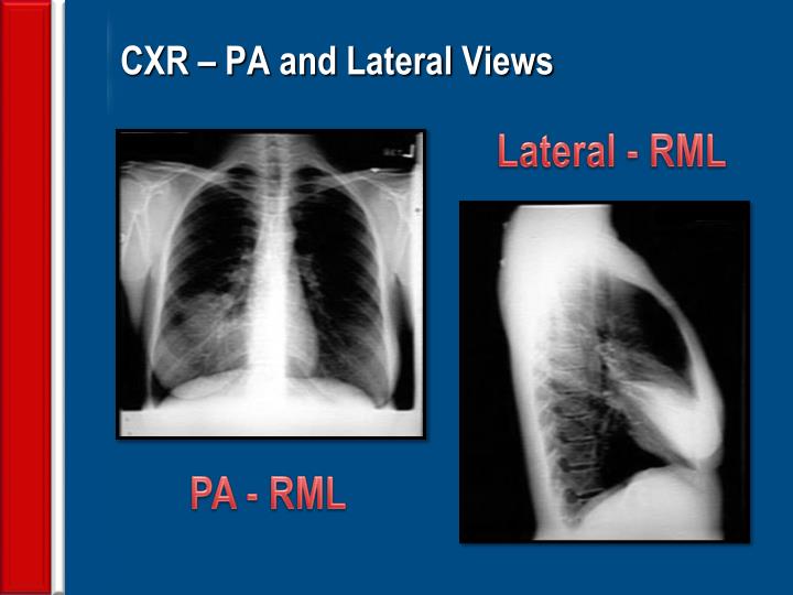 PPT - Community Acquired Pneumonia (CAP) by PowerPoint Presentation ...