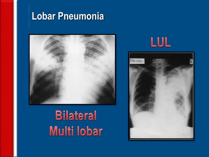 PPT - Community Acquired Pneumonia (CAP) by PowerPoint Presentation ...