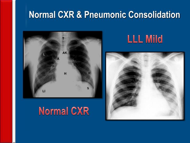 PPT - Community Acquired Pneumonia (CAP) by PowerPoint Presentation ...