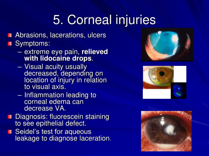 PPT - Ocular Emergencies PowerPoint Presentation - ID:1259257
