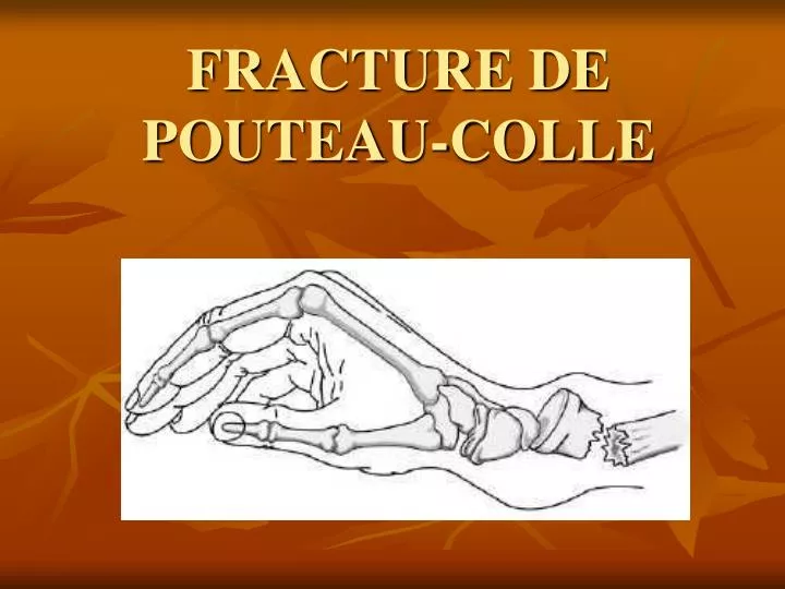 PPT - FRACTURE DE POUTEAU-COLLE PowerPoint Presentation, free download ...
