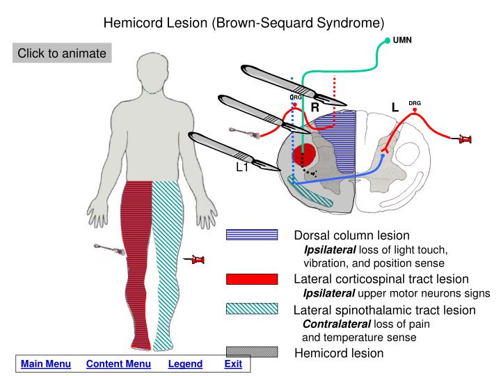 PPT - Lesions of the Spinal Cord PowerPoint Presentation - ID:1265796